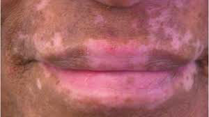 Hyper / Hypo Pigmentation - Cosmopolitan Academy